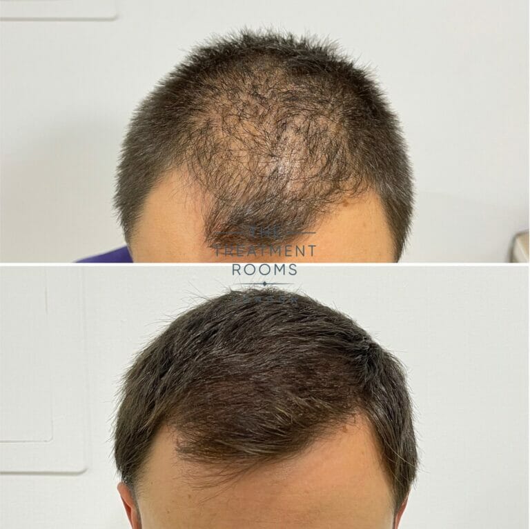 Fue Hair Transplant 1240 Grafts Treatment Rooms London