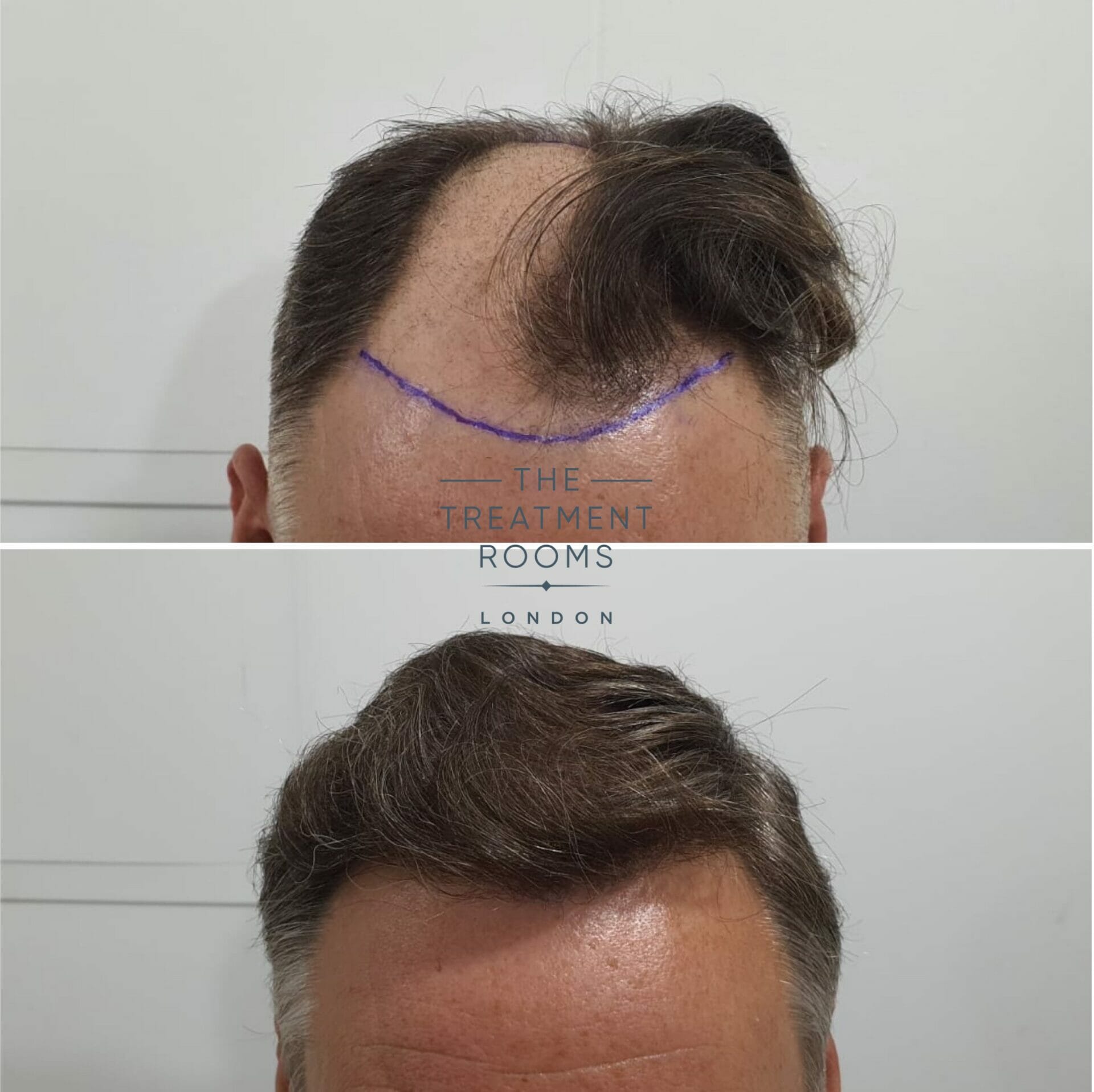 Fue Hair Transplant Result 1824 Grafts Treatment Rooms London