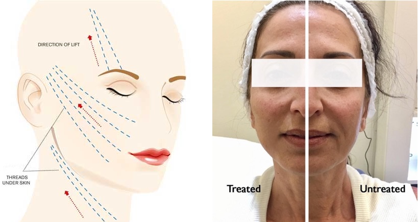 Blog - The Treatment Rooms London - PDO Thread Lifts Face & Body