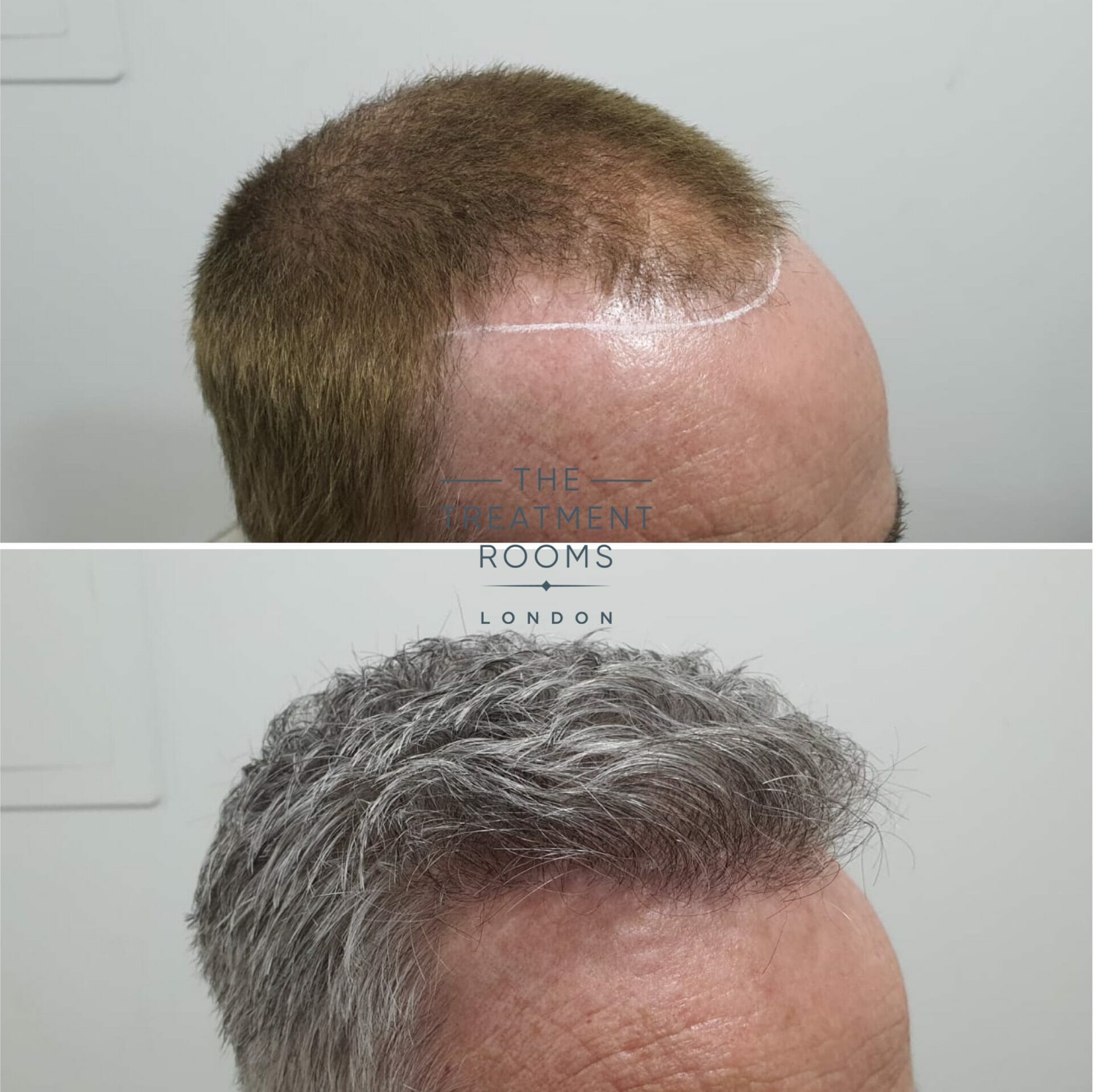 Fue Hair Transplant Result 2322 Grafts Treatment Rooms London