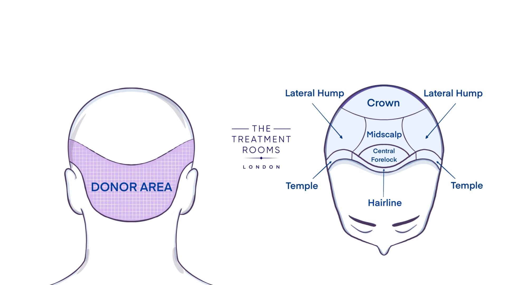 Can You Get A Buzz Cut After A Hair Transplant? - Hair Transplant ...