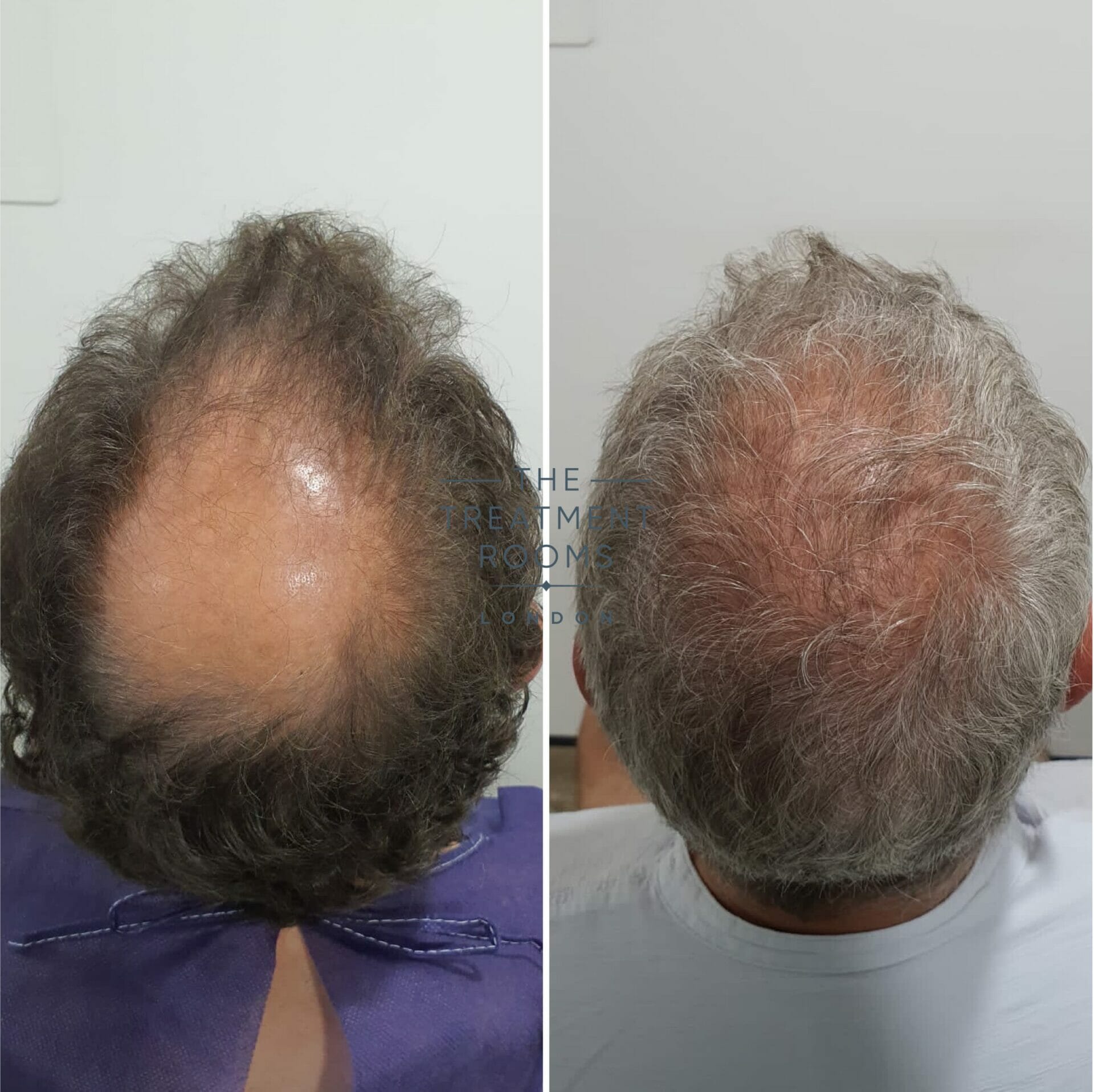 Fue Hair Transplant Result 2110 Grafts Treatment Rooms London