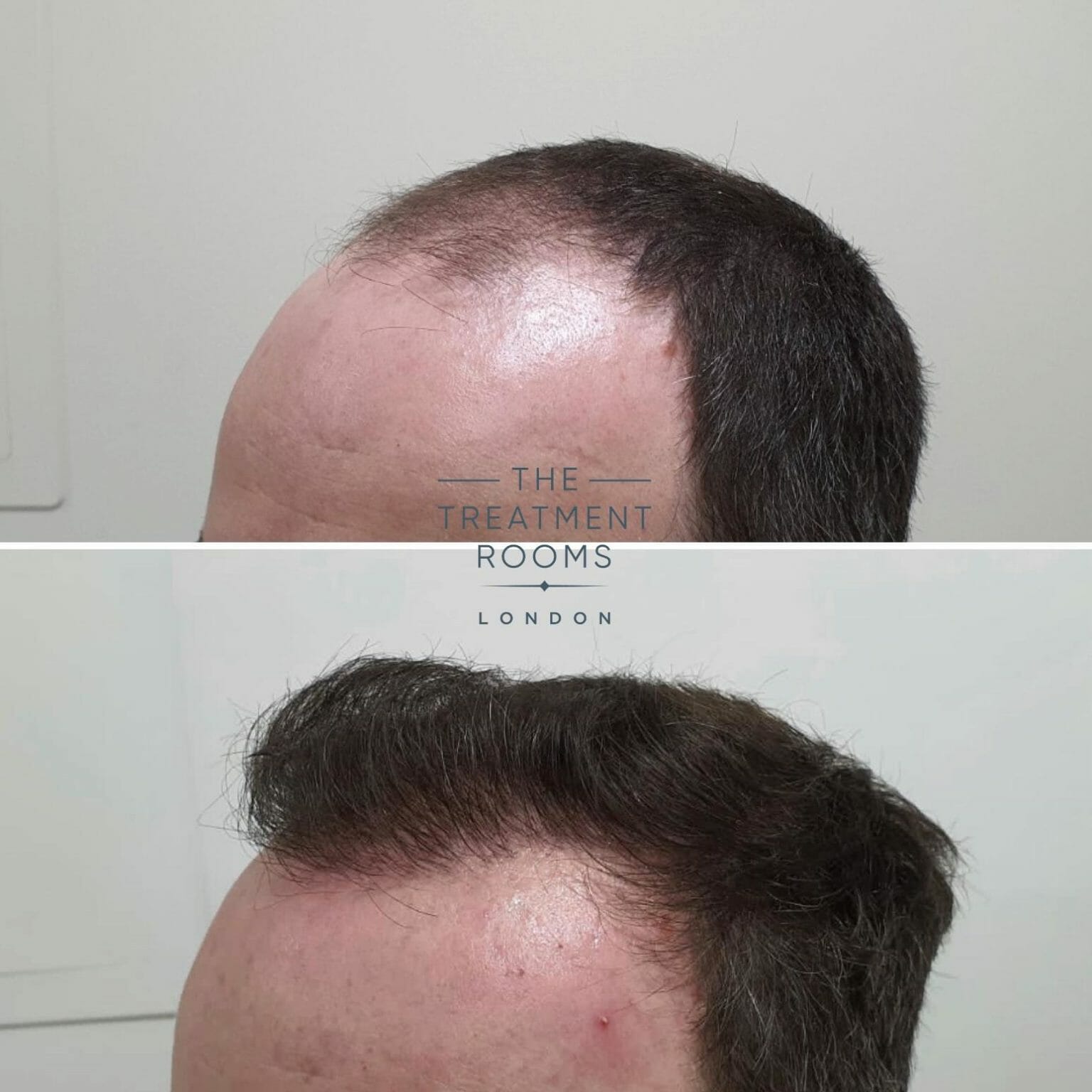 FUE Hair Transplant Before And After | Treatment Rooms London