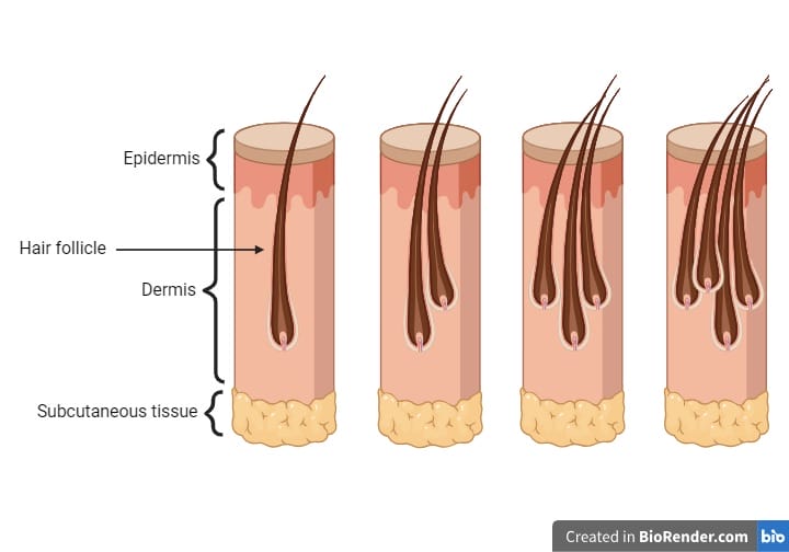 What Is A Hair Graft In A Hair Transplant? - Hair Transplant ...