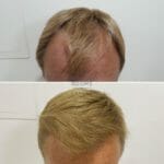 Norwood 3 Hair Loss: Everything You Need To Know | Get In Touch