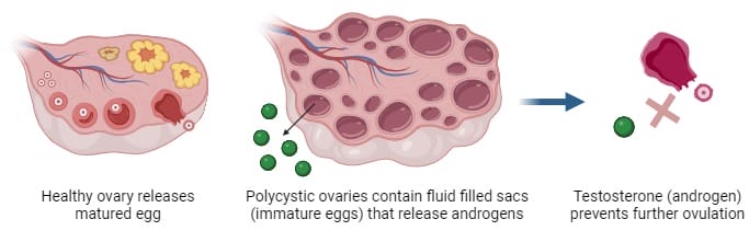 Polycystic Ovary Syndrome (PCOS) and Hair Loss: What You Need to Know ...