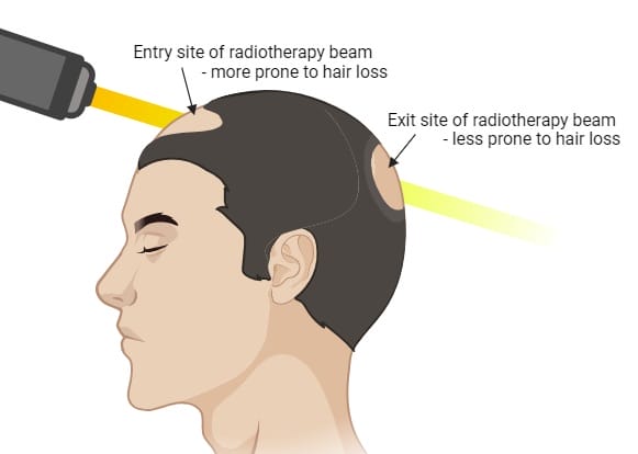 Does Radiotherapy Cause Hair Loss? - Hair Transplant Specialists ...