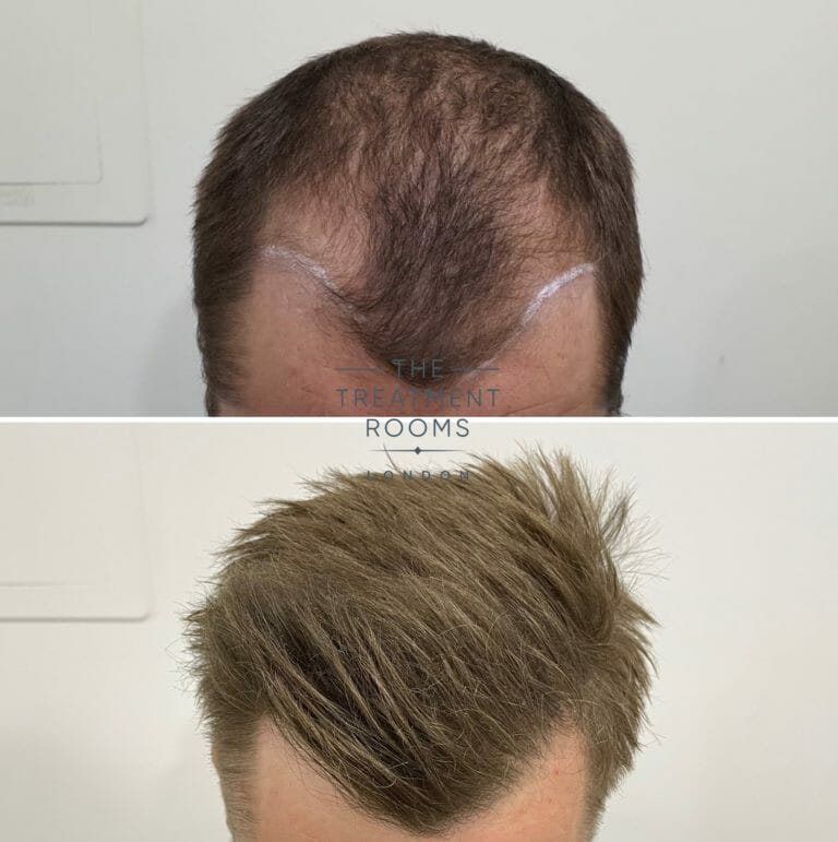 Temple Hair Loss & Temple Hair Transplant | Treatment Rooms London