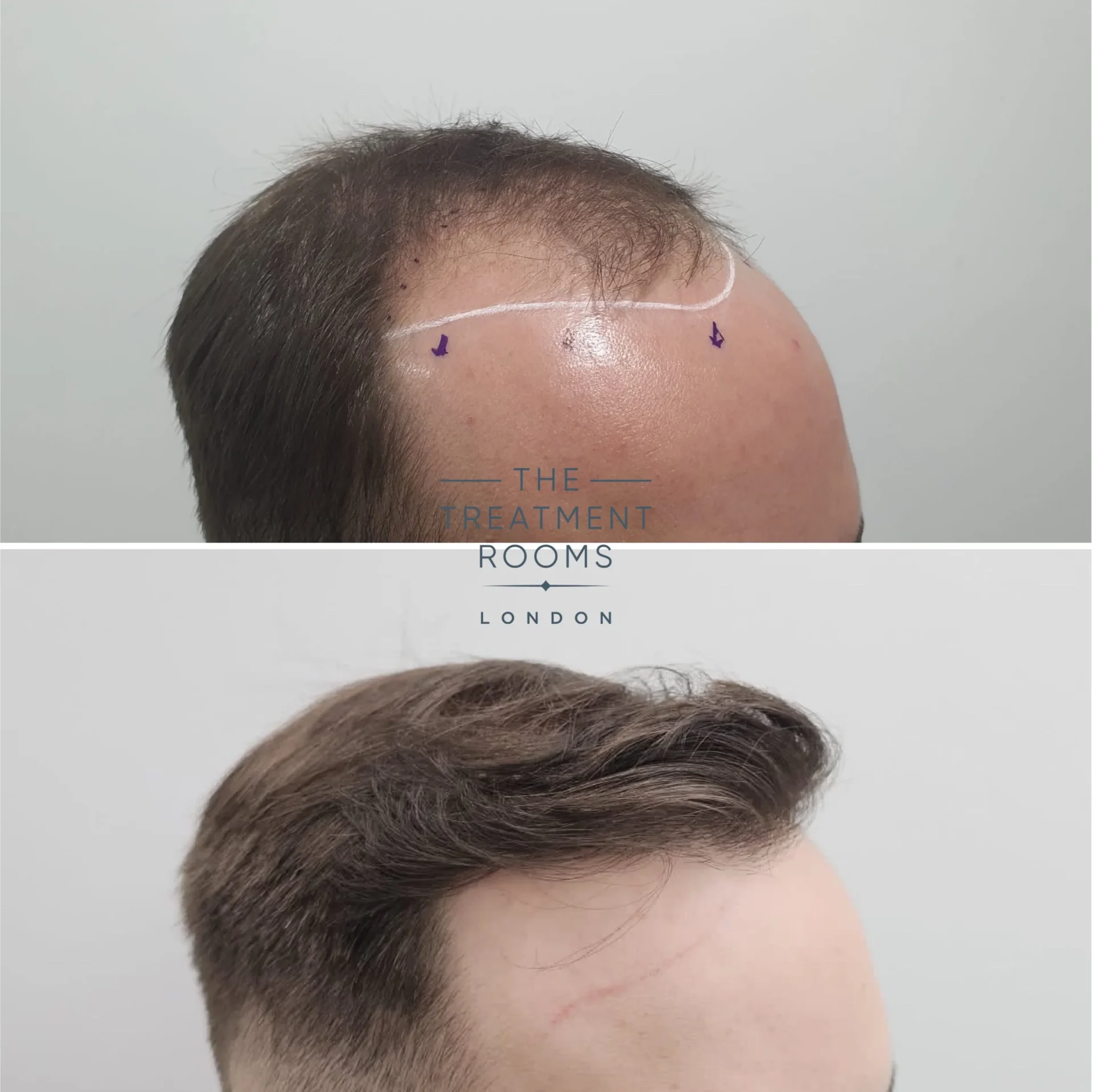 Fue Hair Transplant Result 2187 Grafts Treatment Rooms London