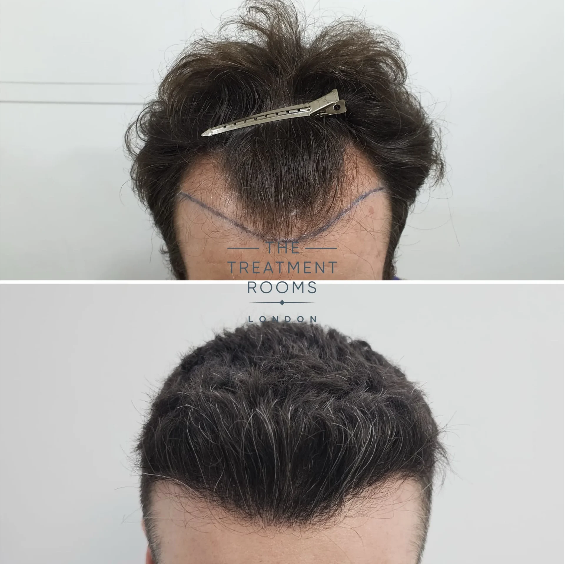 Fue Transplant Before And After Treatment Rooms London