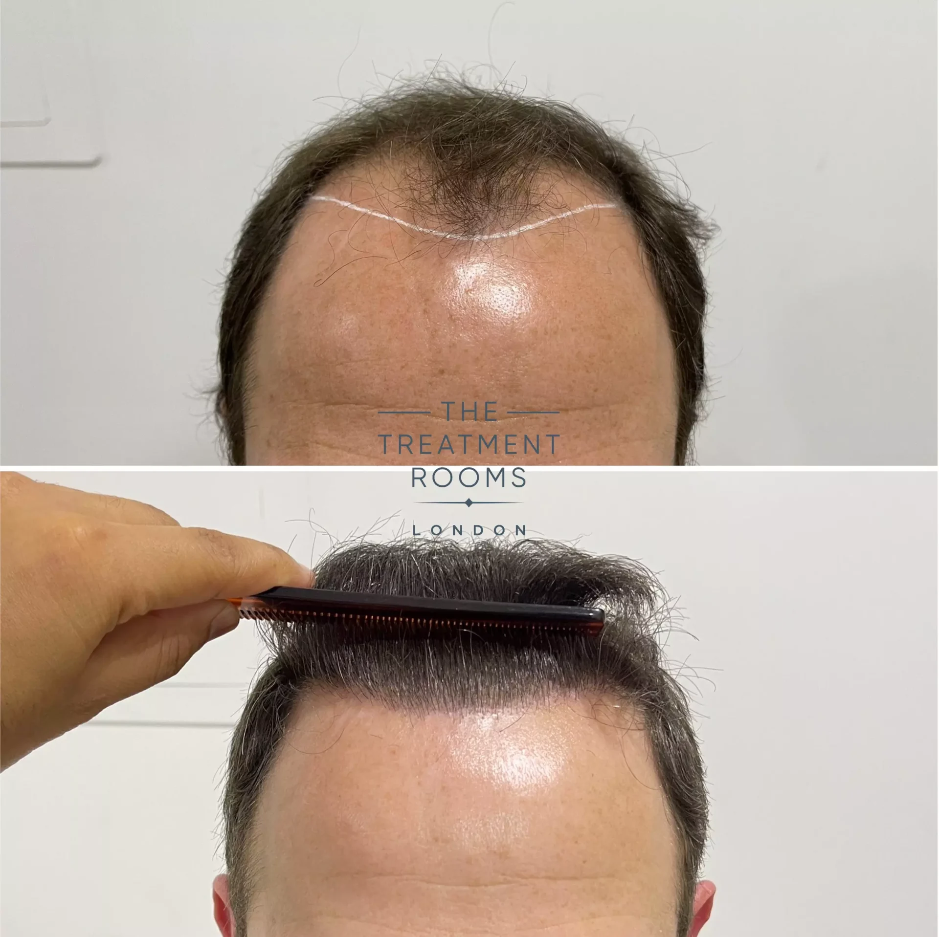 Fue Hair Transplant Result 2076 Grafts Treatment Rooms London