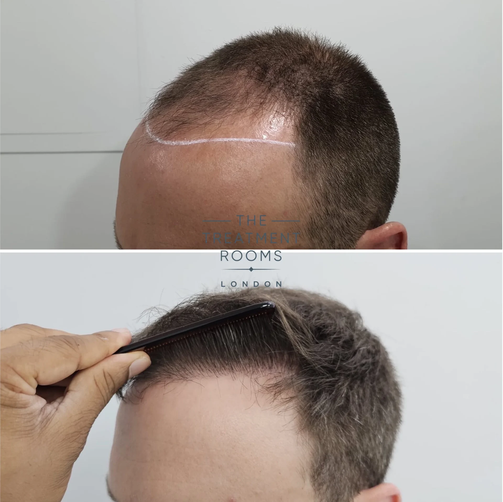 Fue Hair Transplant Result 3299 Grafts Treatment Rooms London