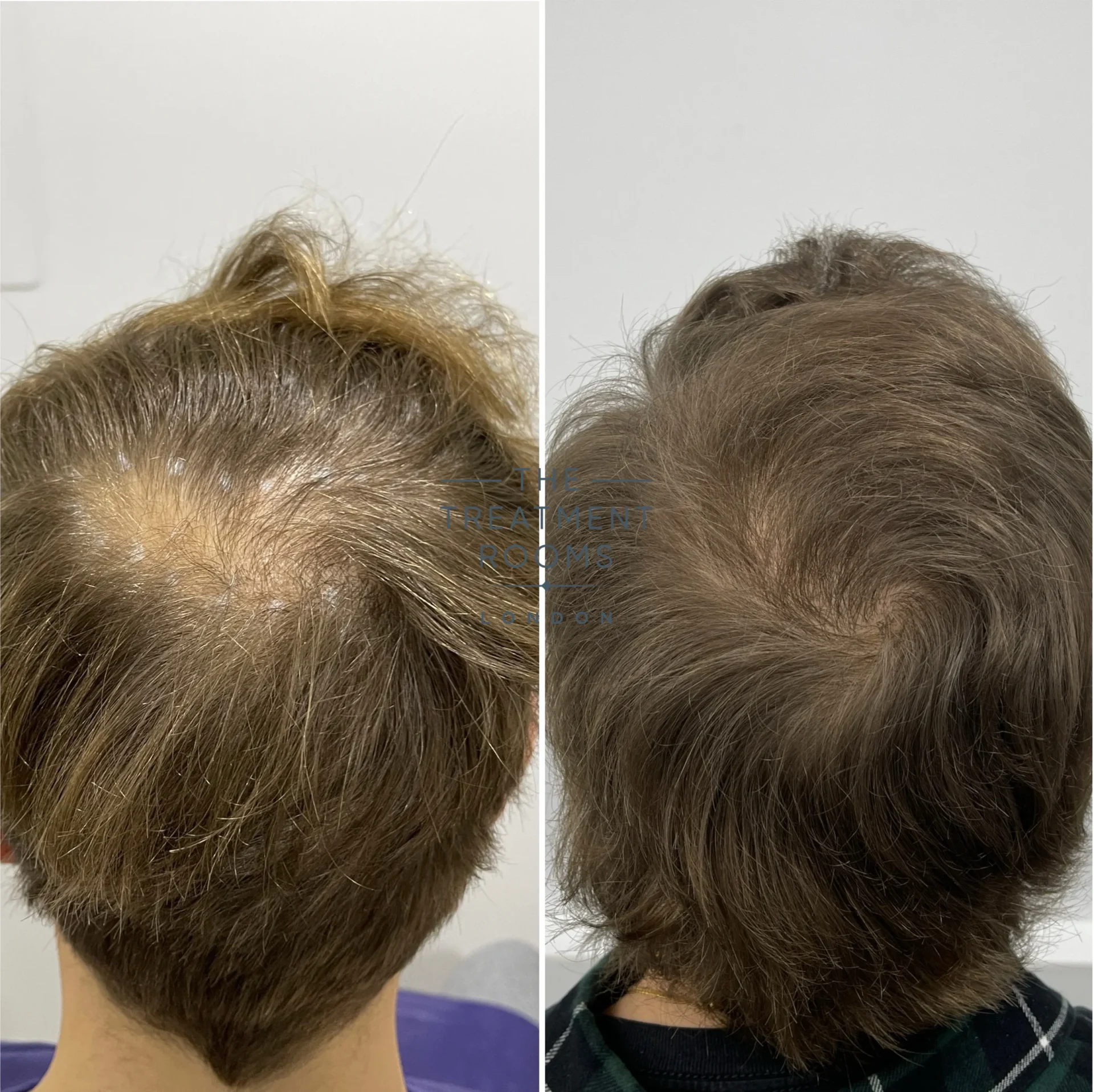 Fue Hair Transplant Result 2037 Grafts Treatment Rooms London