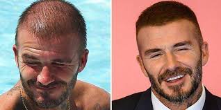 David Beckham Hair Transplant | Treatment Rooms London