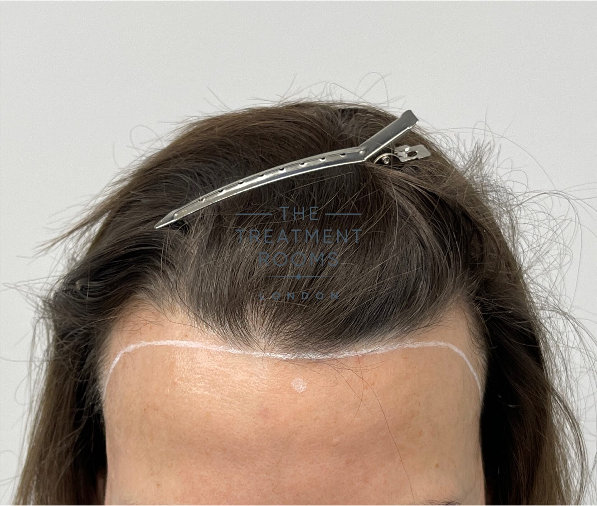 Female Hairline Lowering Transplant - Hair Transplant Specialists ...