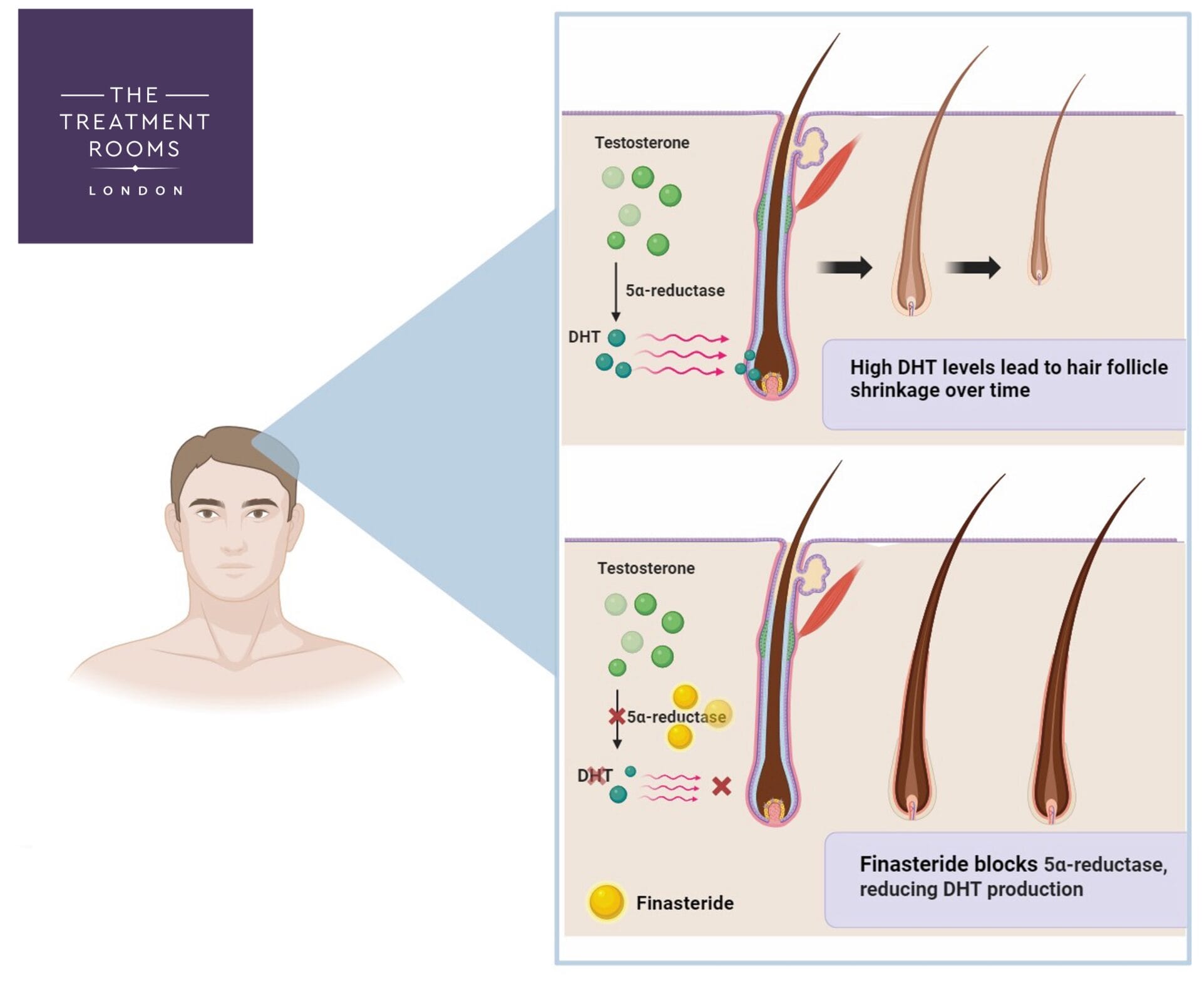 Guide To Finasteride For Hair Loss | Hair Transplant London