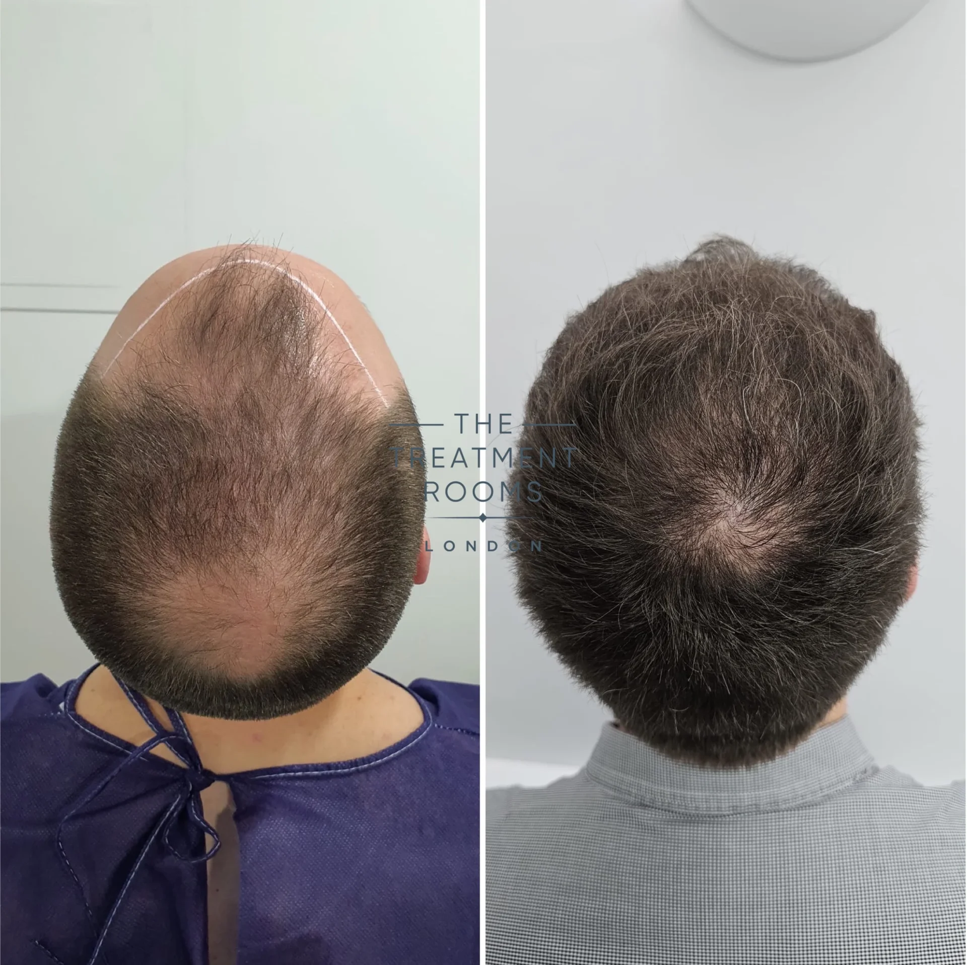 FUE Hair Transplant Result 3299 grafts - Treatment Rooms London