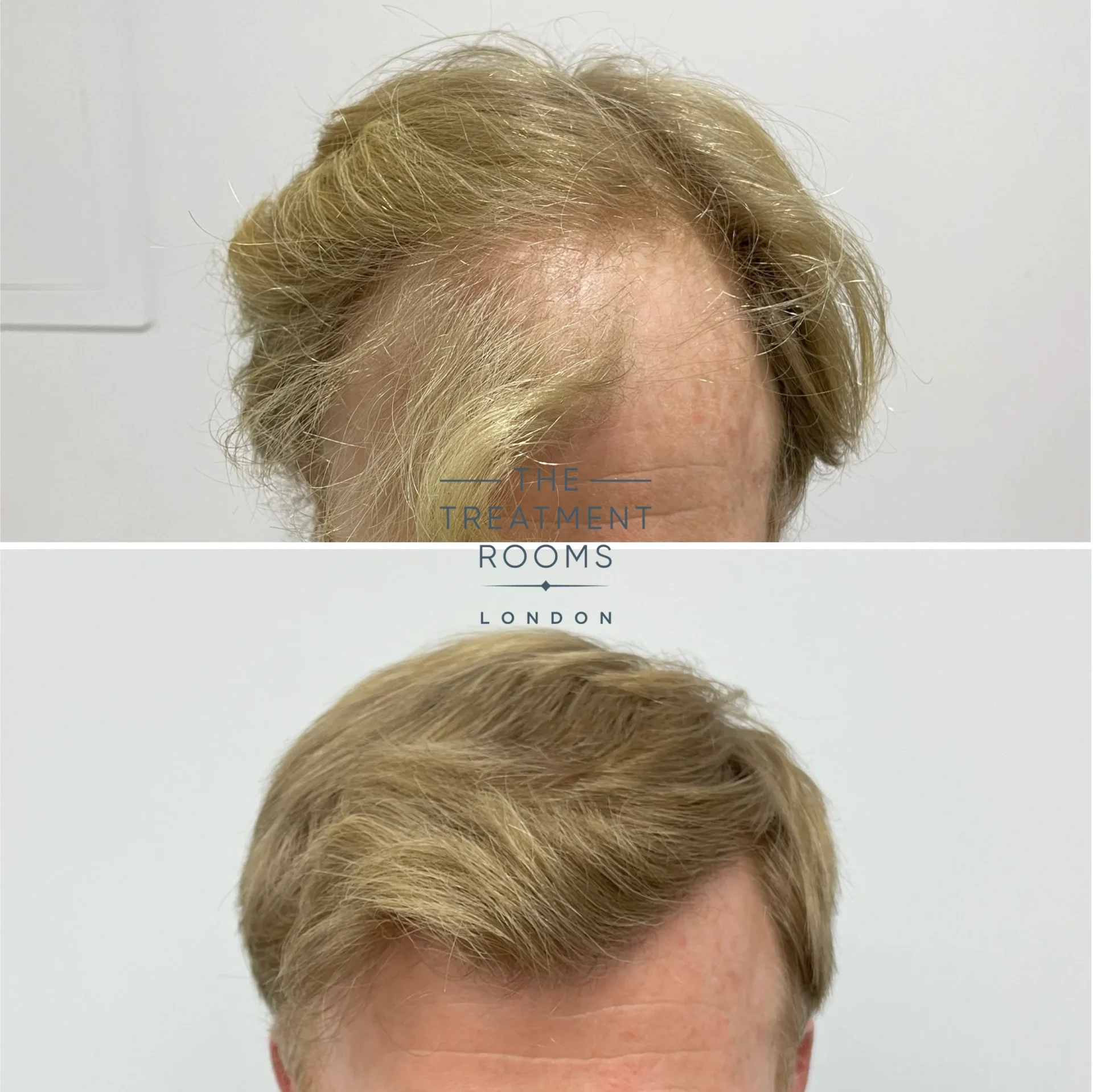 Fue Hair Transplant Result 2087 Grafts Treatment Rooms London