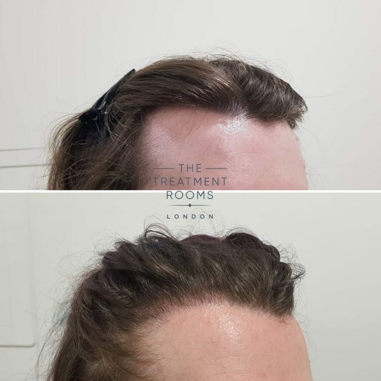 Transgender Hair Transplants | Treatment Rooms London