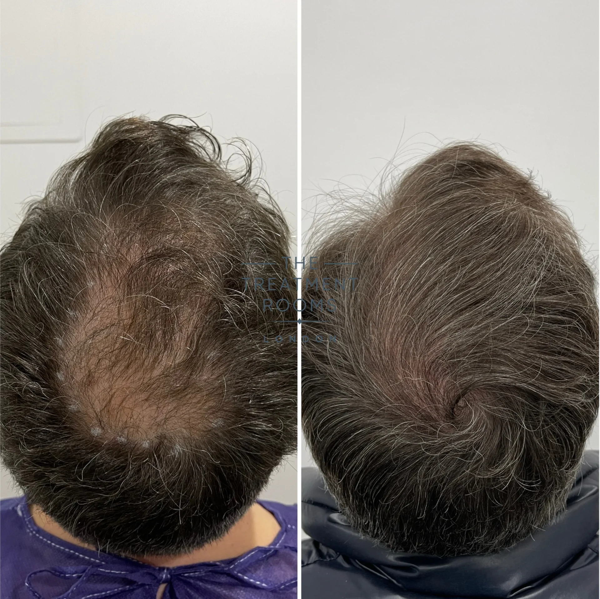 A Guide To Double Crowns: What Are They? - Hair Transplant Specialists ...