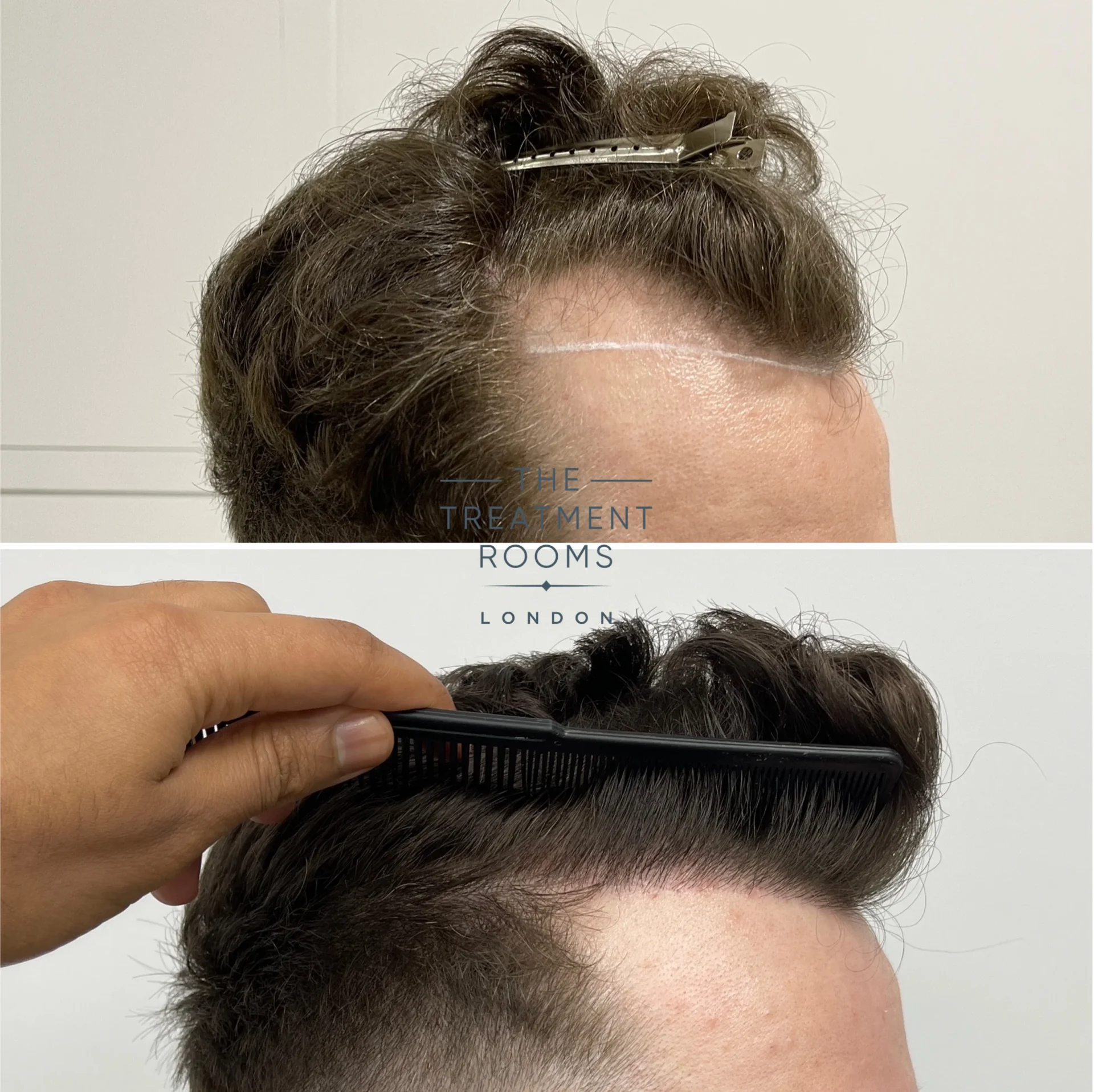 Temple Hair Loss & Temple Hair Transplant | Treatment Rooms London