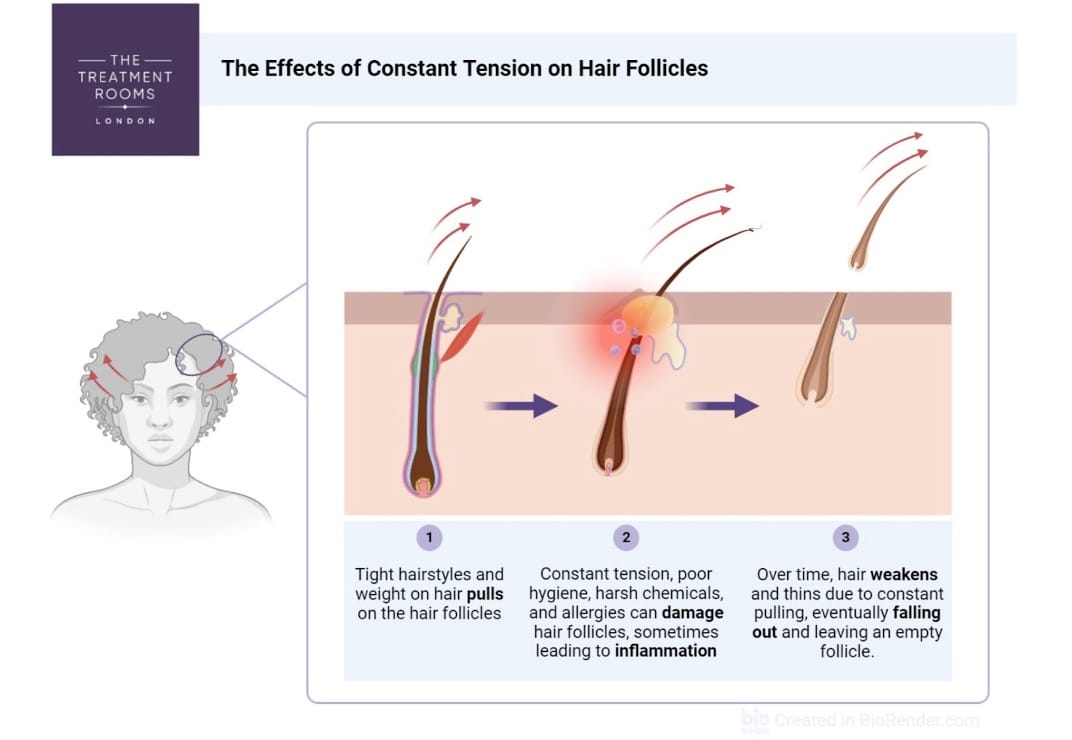 Receding Hairline In Women - What You Need To Know - Hair Transplant ...