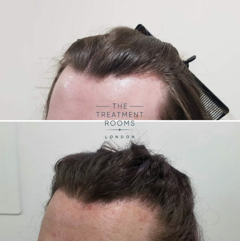 What You Need To Know About Transgender Hair Transplants | Treatment ...