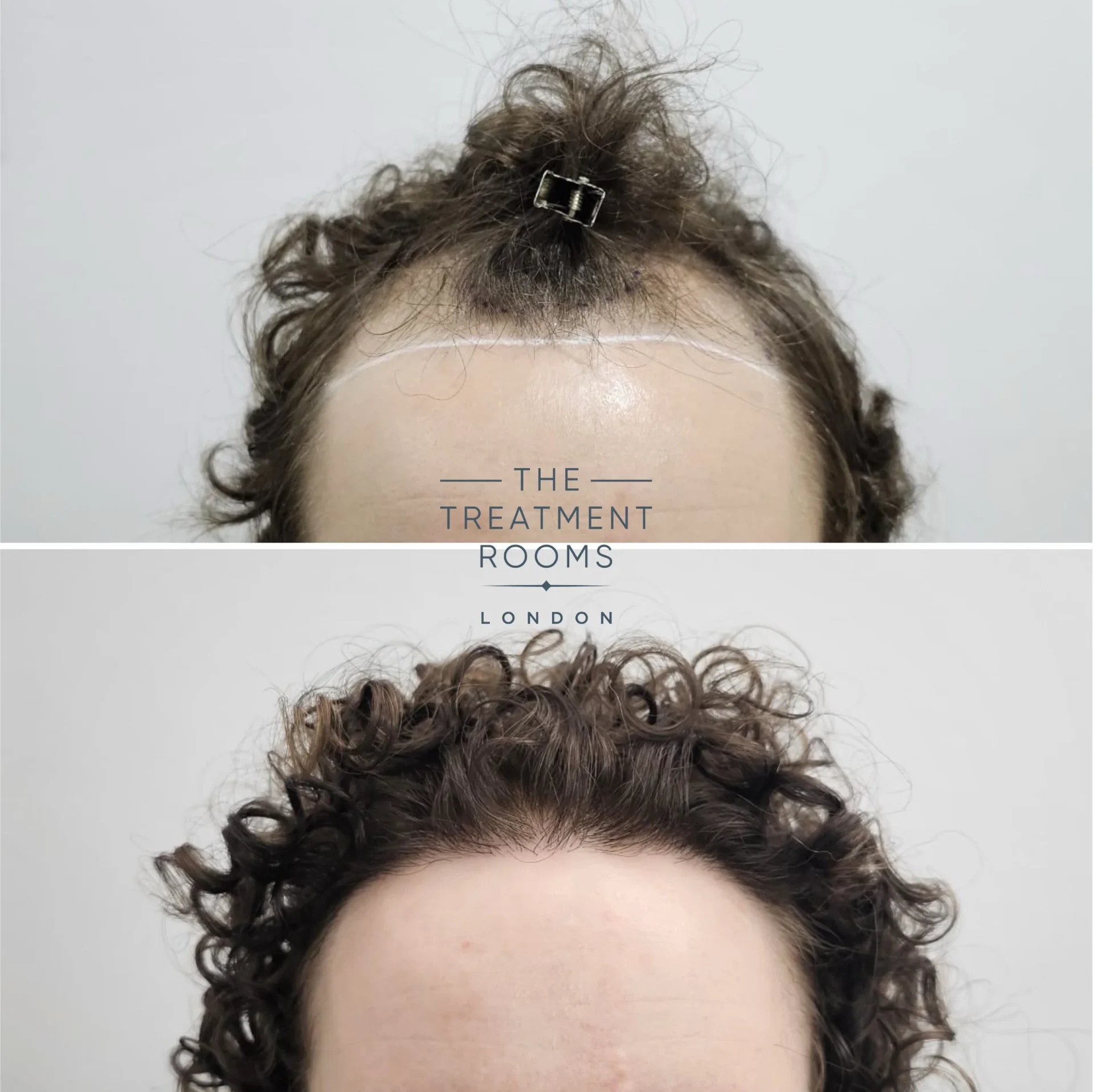 Transgender Hair Transplant Result 1407 Grafts Treatment Rooms London